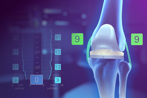 Exactech | Orthopaedic Implants | Joint Replacement