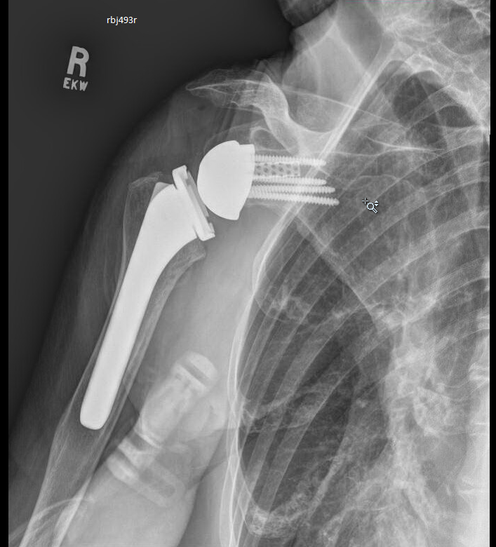 Innovations | Insights in Computer-Assisted Surgery for TSA