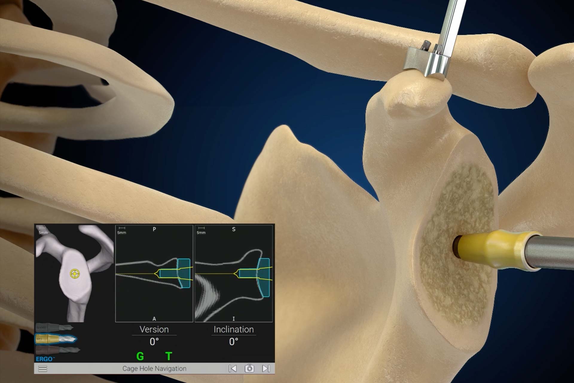 Using GPS to assess glenoid morphology in reverse shoulder arthroplasty ...