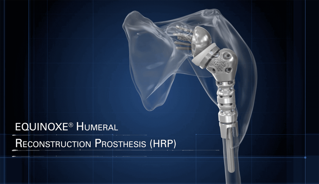 Equinoxe Humeral Reconstruction Prosthesis Archives | www.exac.com