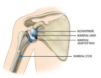 Exactech Recall Information | Surgeons and Patients