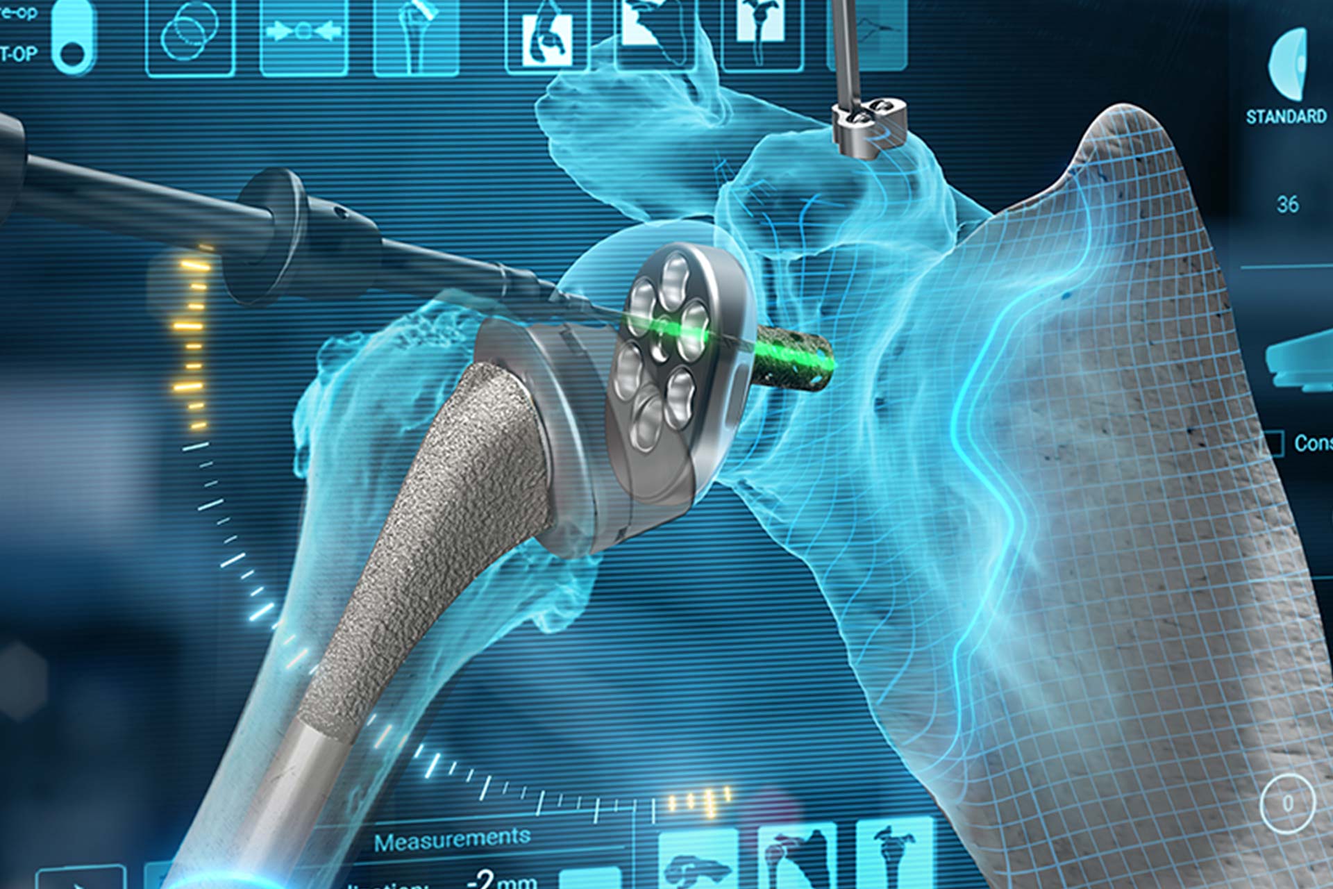 Revision reverse shoulder arthroplasty for the management of baseplate ...