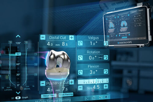 Exactech GPS Navigation | Active Intelligence Technology