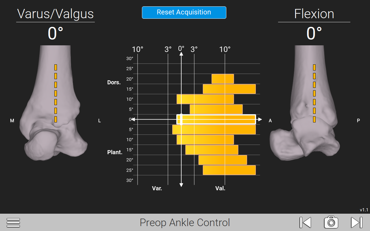 GPS Ankle | Navigation in Total Ankle Arthroplasty | Exactech