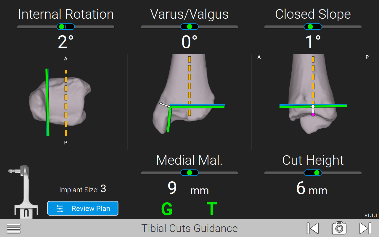 GPS Ankle | Navigation in Total Ankle Arthroplasty | Exactech