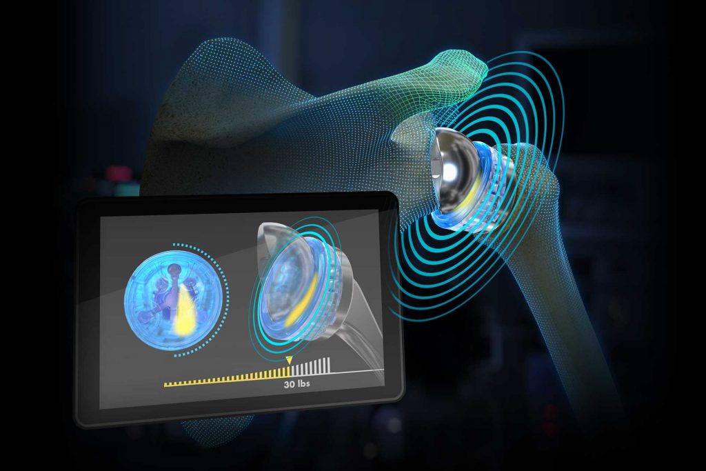 Optimal Tension in Reverse Total Shoulder Replacement: A Tool to Help ...