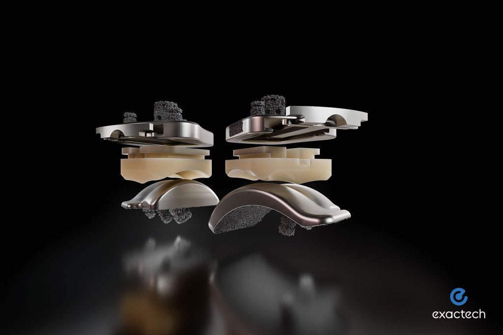 Father of Exactech Employee Receives First Ankle Replacement Using ...