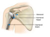 Exactech Recall Information | Surgeons and Patients