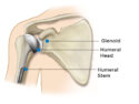 Exactech Recall Information | Surgeons and Patients